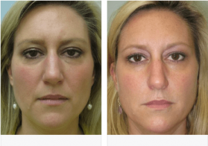 BOTOX Cosmetic in Cranston Providence Rhode Island